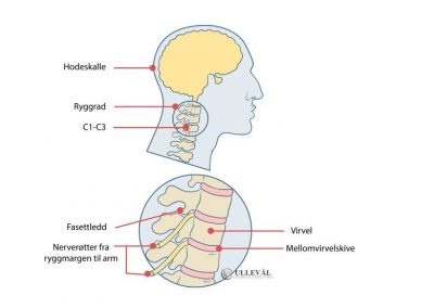 Enkel innføring i cervikogen hodepine? | Ullevål Kiropraktorklinikk
